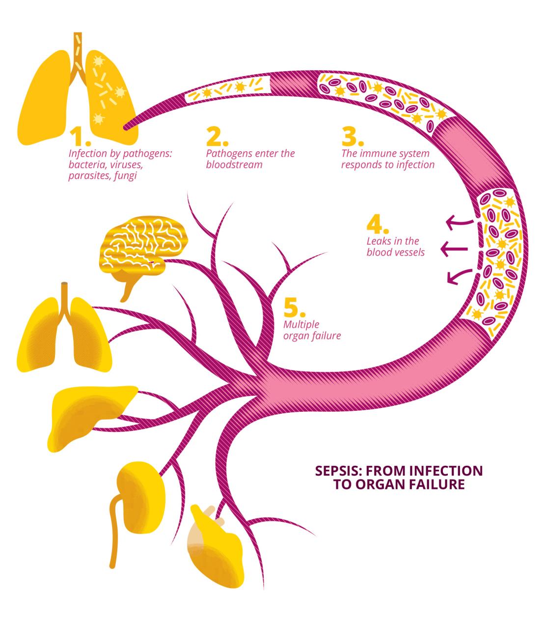 Sepsis: a long-term battle, new issues and goals | Sciences
